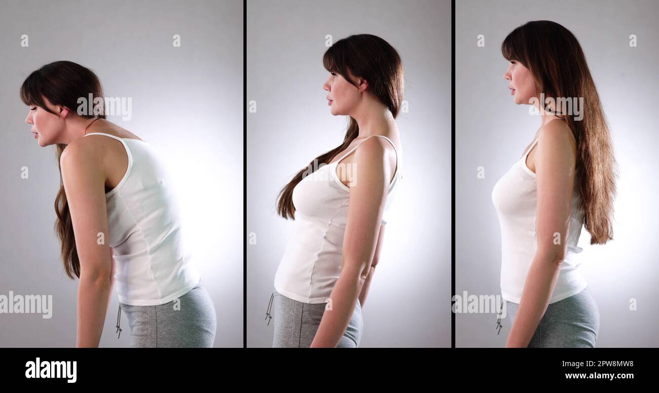 Head Forward Posture, Lordosis, Kyphosis And Scoliosis Stock Photo - Alamy