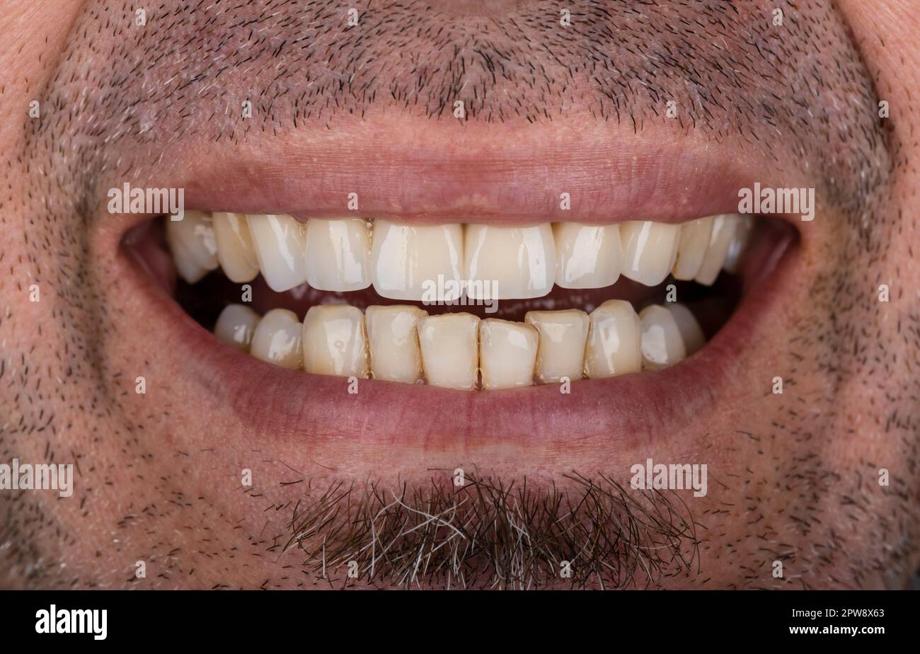 Close-up male teeth. Zirconium crown upper teeth Stock Photo - Alamy