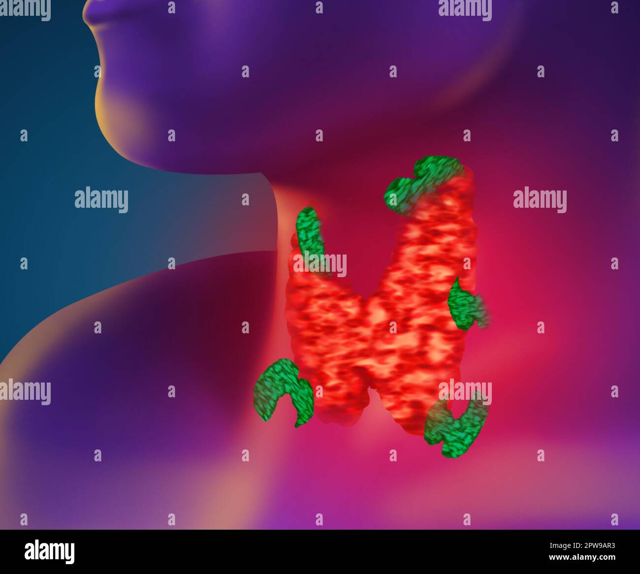 Illustration of human with inflamed thyroid gland on color background ...