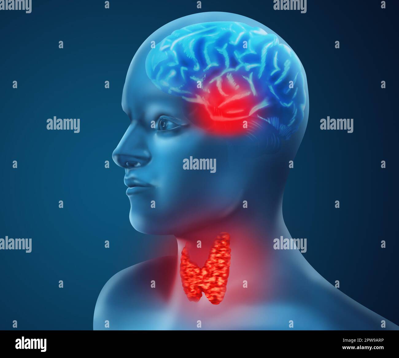 Illustration of human with inflamed thyroid gland on color background ...