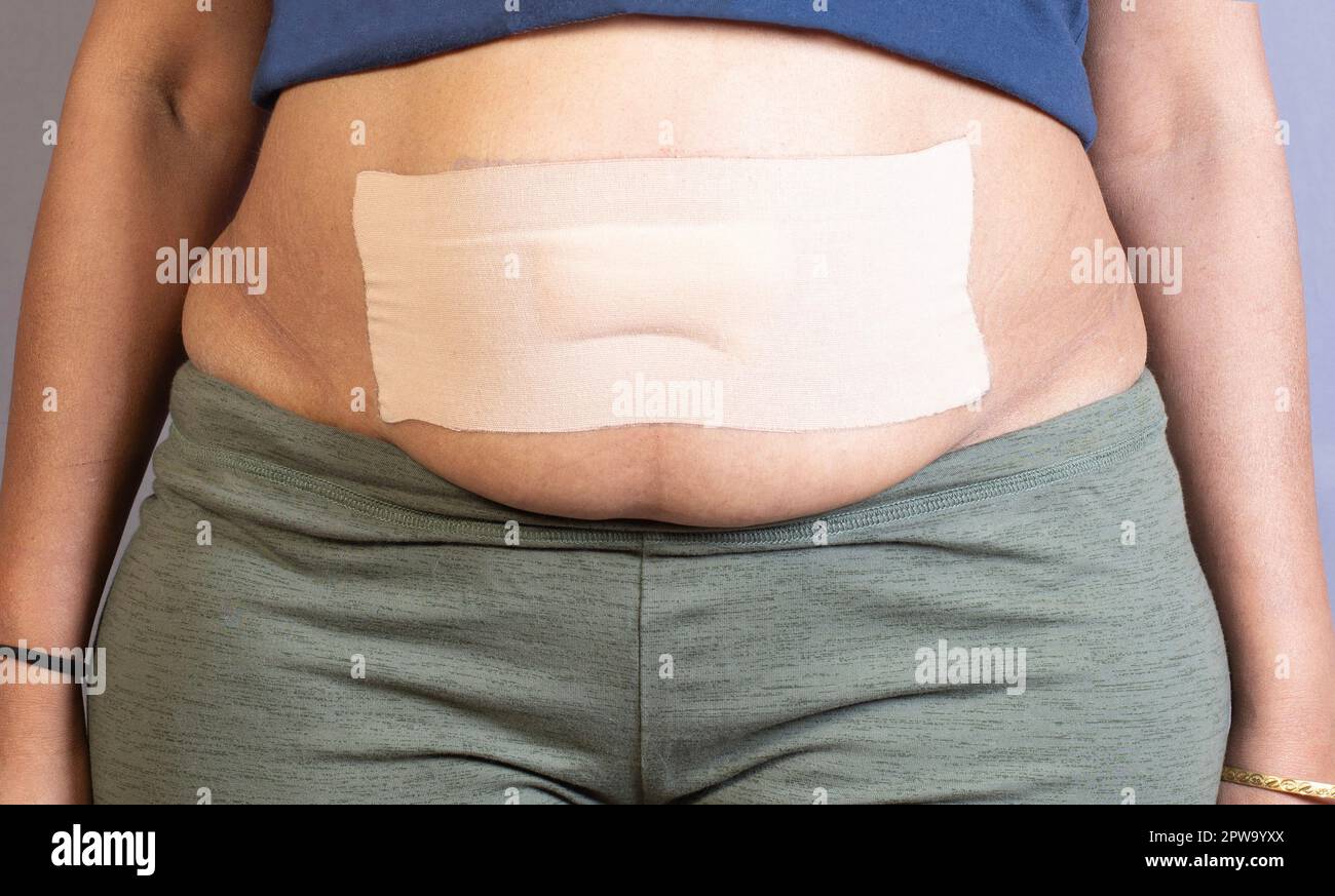 Bandage applied across the midriff of a woman after an operation of the belly button or navel ...
