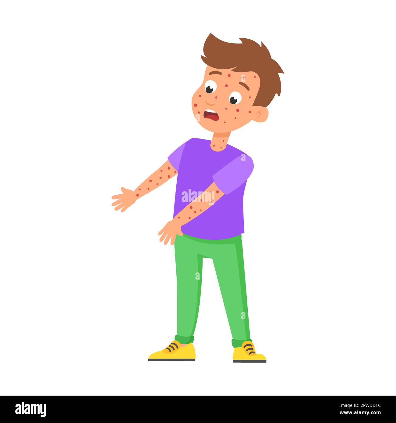 boy with large rash on his arms with signs of chickenpox disease. Cute ...