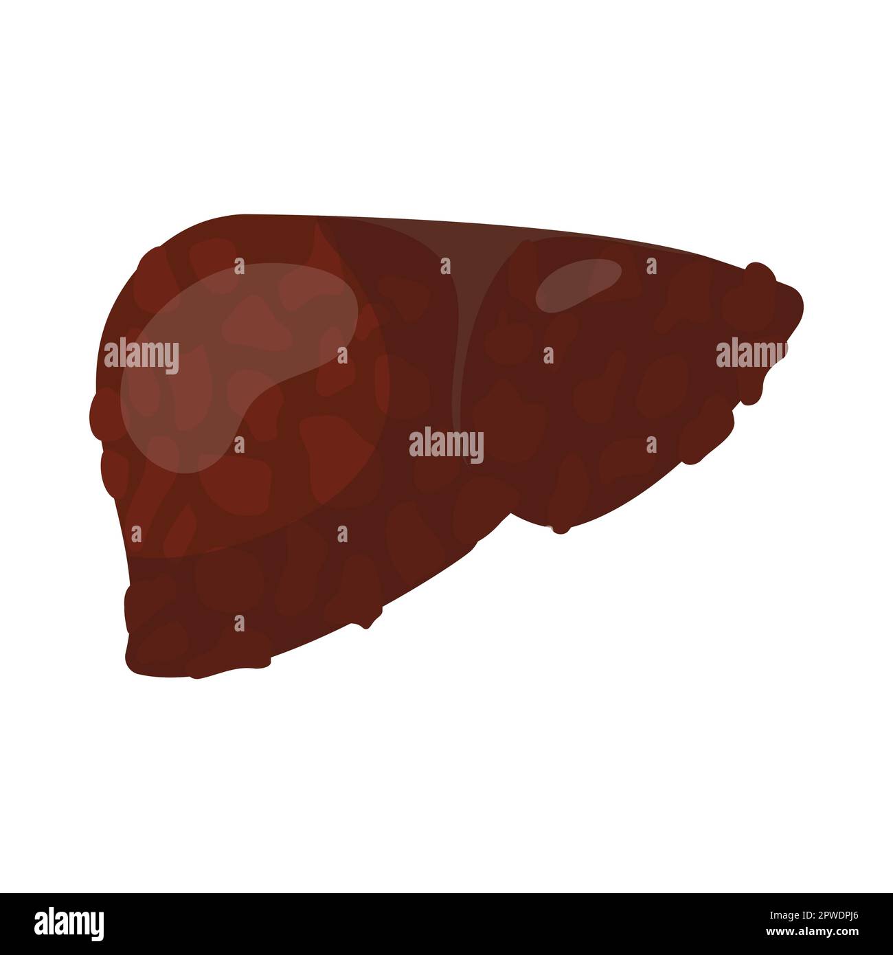 Liver fibrosis or cirrhosis of sick patient cartoon illustration Stock ...