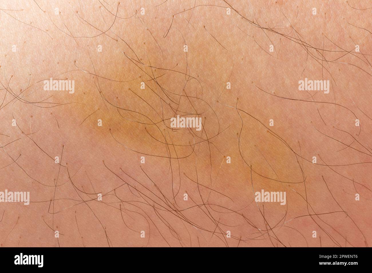 Skin injury hi-res stock photography and images - Alamy