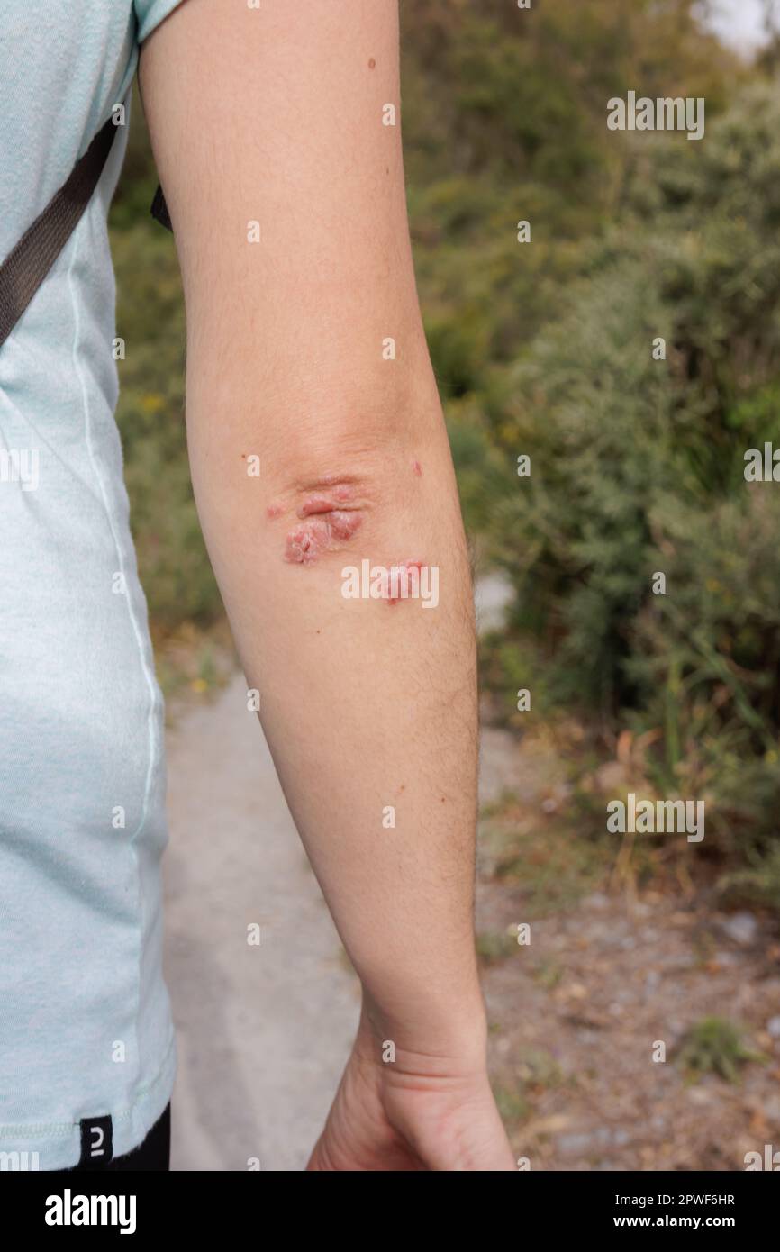Arm of a woman with a skin rash on her elbows taking a walk in the ...
