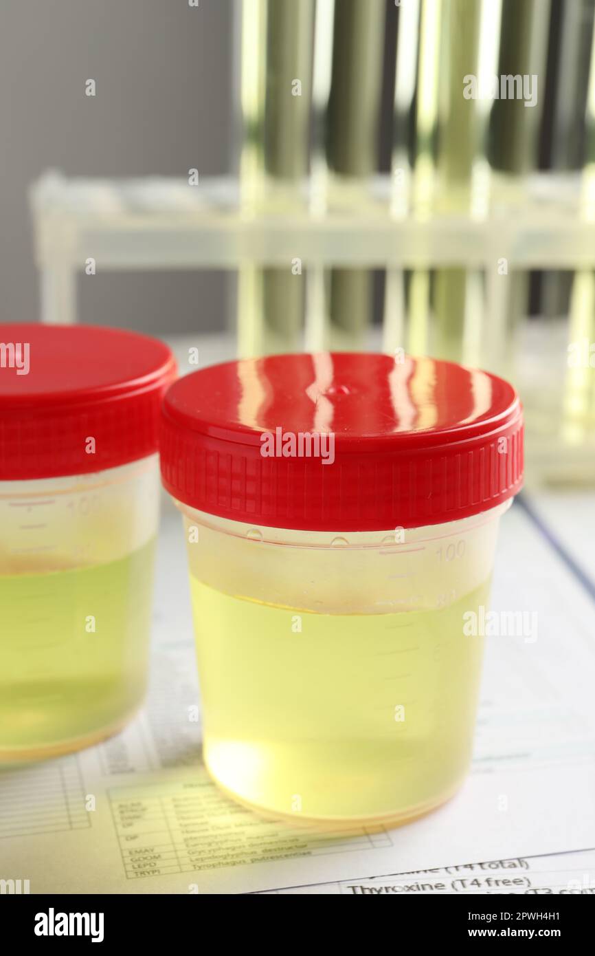 Containers with urine sample for analysis on test form in laboratory ...