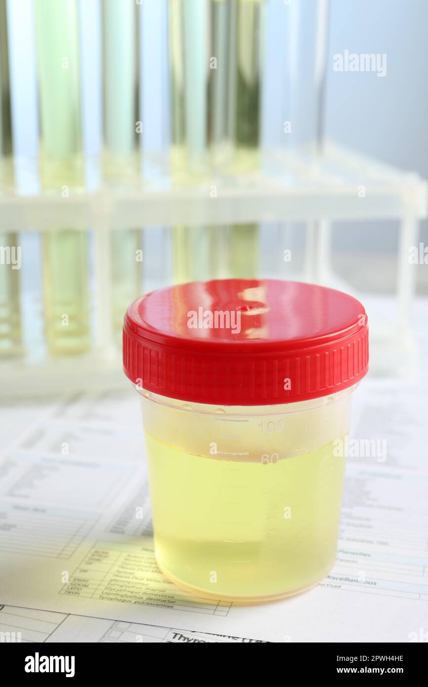 Container with urine sample for analysis on test forms in laboratory ...