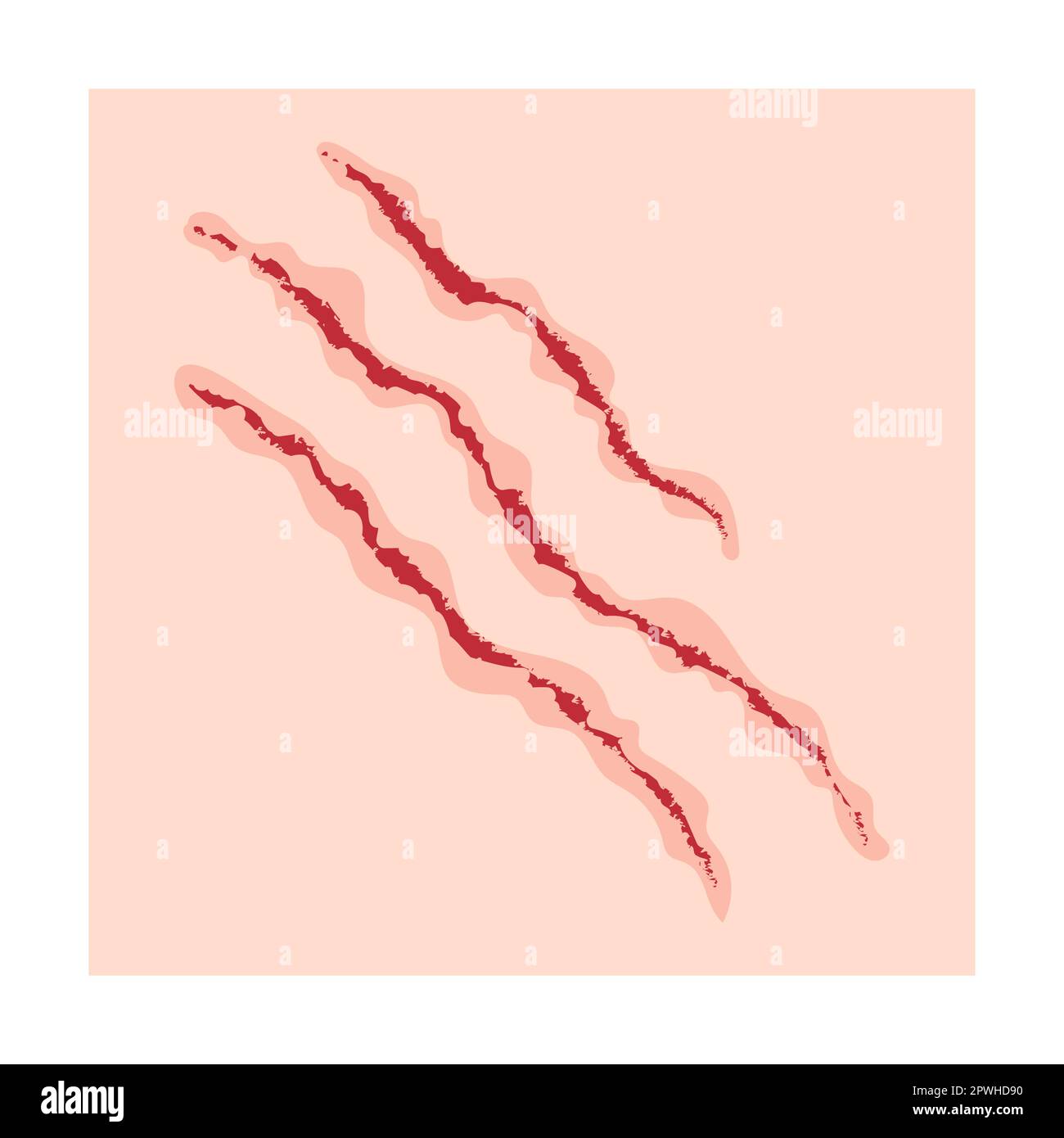 Scar with stitches cartoon illustration. Bloody wound, injures, scratches, bruises, surgical ...