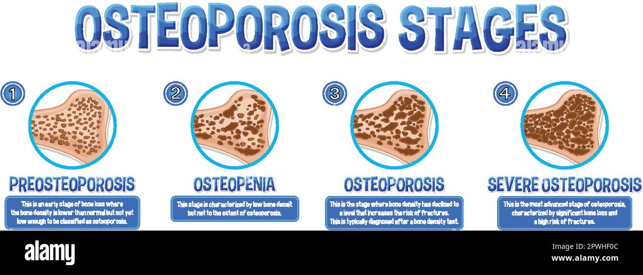 Informative poster of Osteoporosis human bone illustration Stock Vector ...