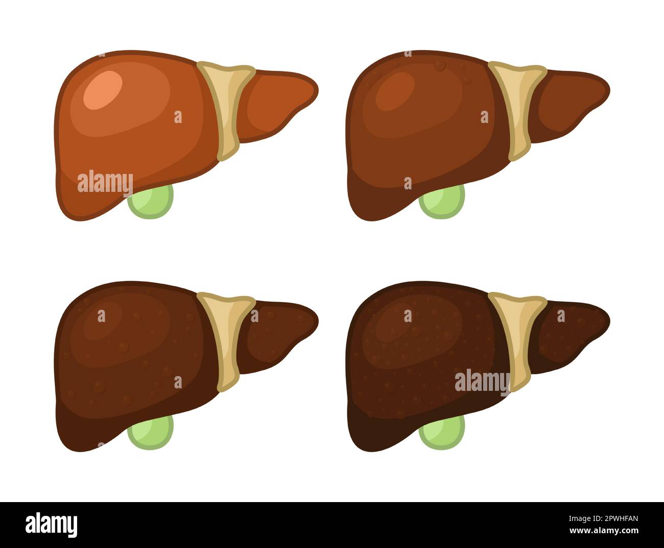 Liver cirrhosis drawing hi-res stock photography and images - Alamy