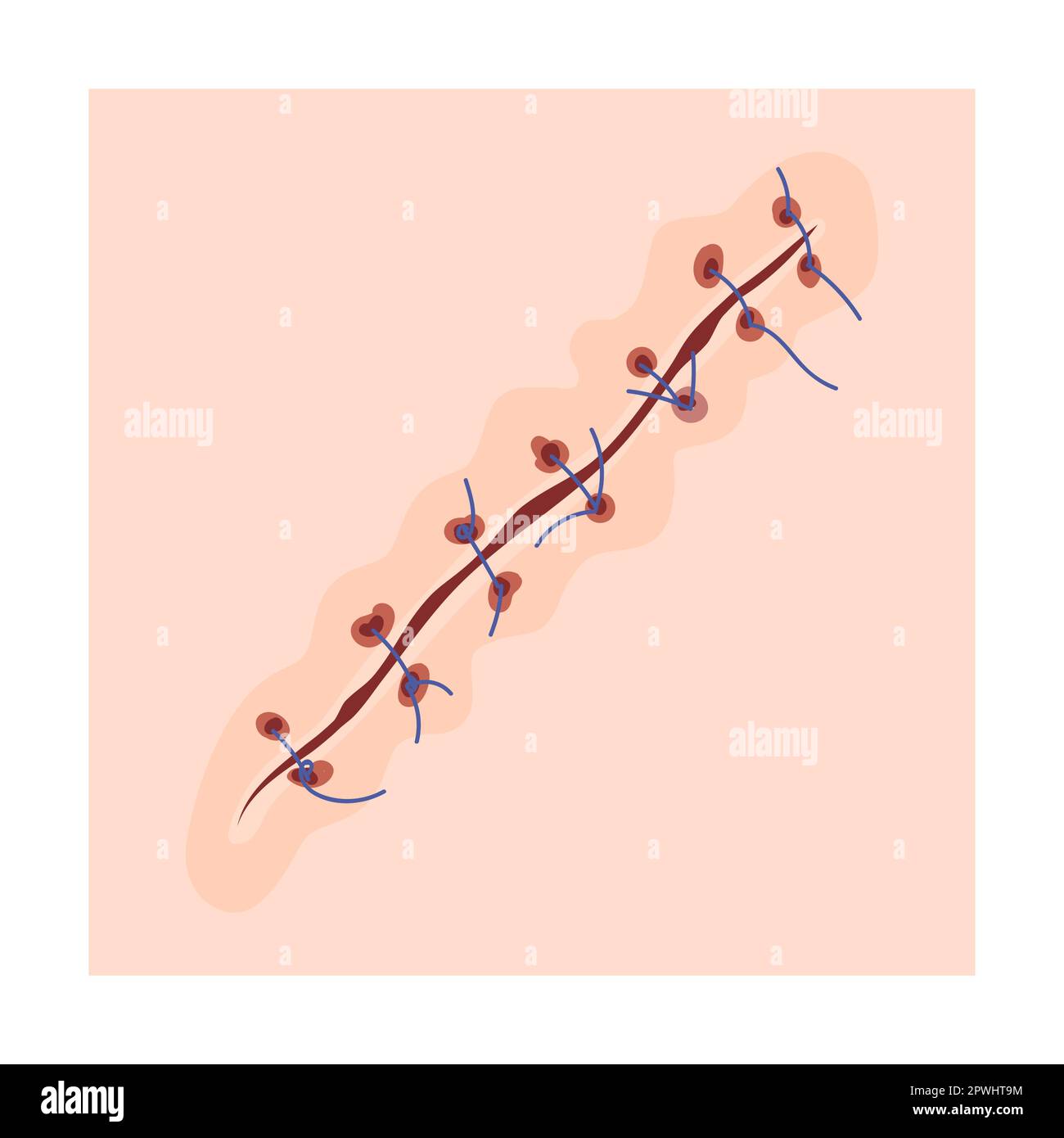 Skin scar with seam cartoon illustration. Bloody wound, injures, scratches, bruises, surgical ...