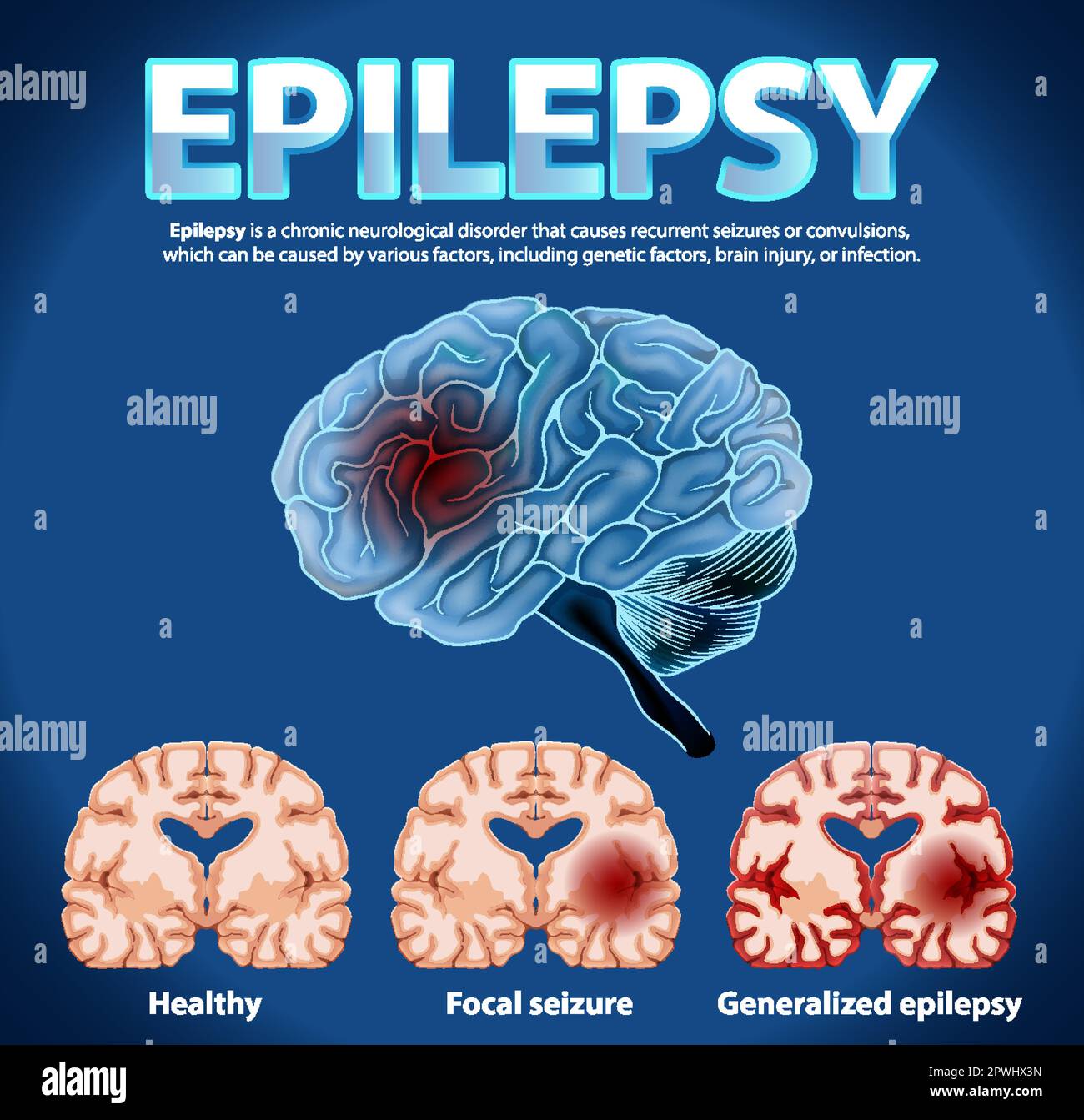 Informative poster of Epilepsy illustration Stock Vector Image & Art ...