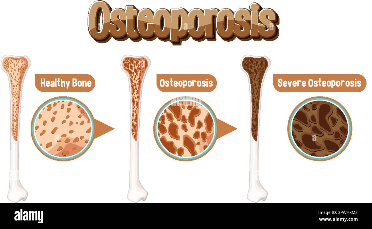 Comparison Of Normal Bone And Bone With Osteoporosis Illustration Stock