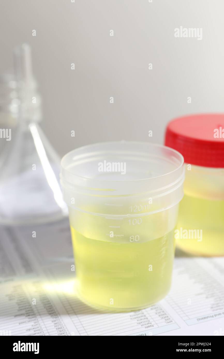Containers with urine samples for analysis and glassware on test forms ...