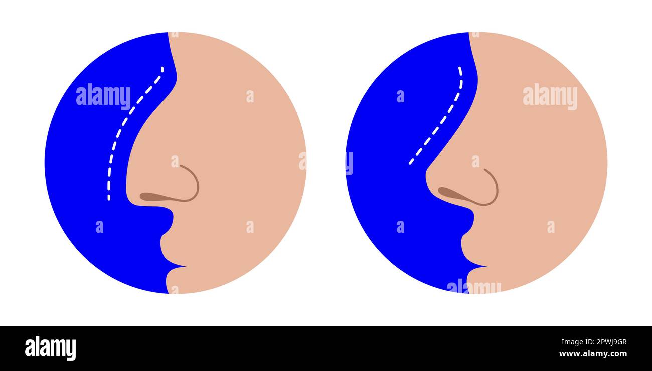 Crooked and straight nose comparison, before and after rhinoplasty correction. Nose plastic ...
