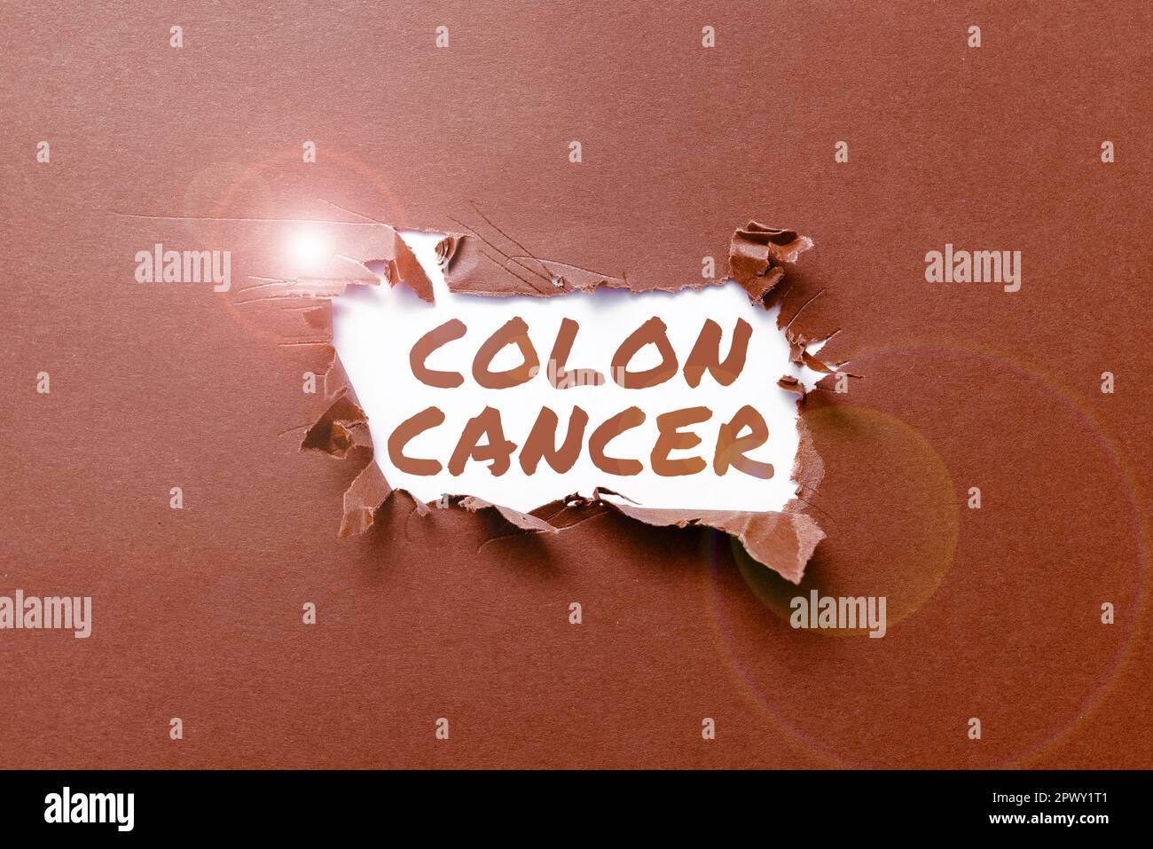 Writing displaying text Colon Cancer, Conceptual photo Cancer that ...