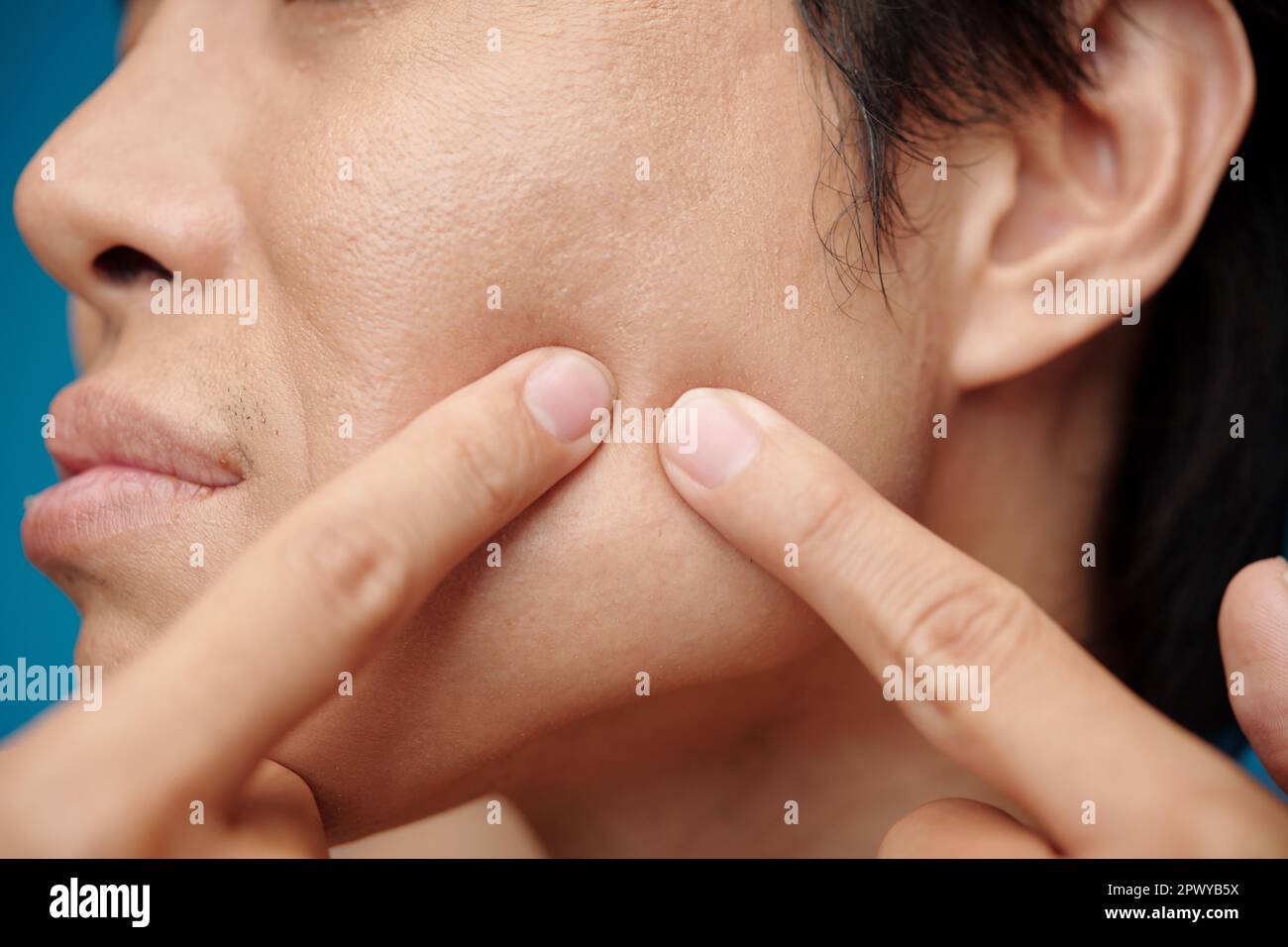 Closeup image of man squeezing pimples after washing face Stock Photo ...