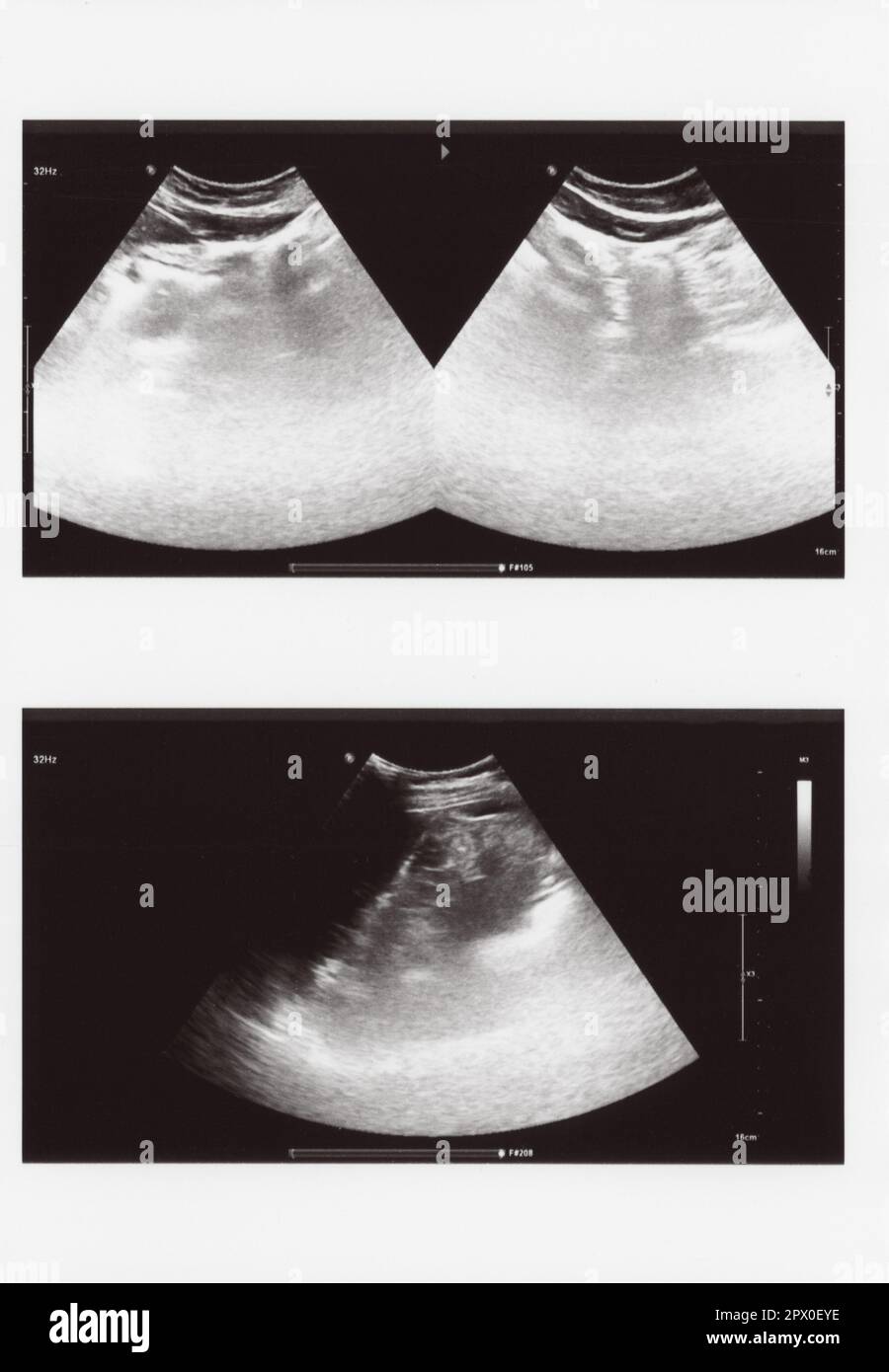 full abdomen ultrasound image aka diagnostic sonogram Stock Photo - Alamy