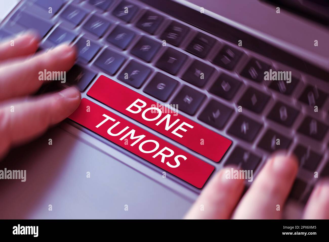 Writing displaying text Bone Tumors, Business idea can be either benign ...