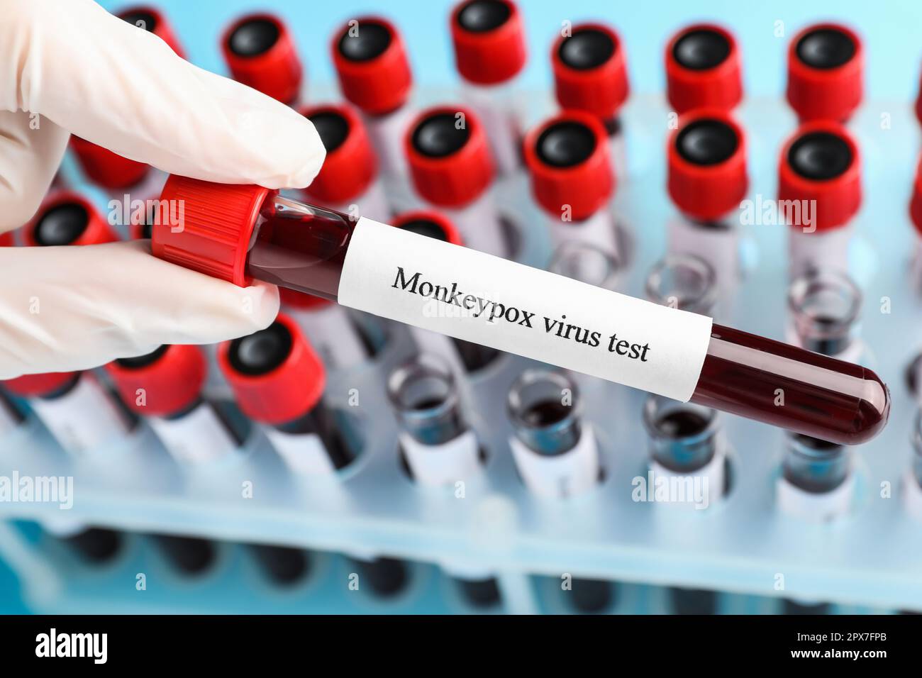 Monkeypox virus test. Laboratory worker holding sample tube with blood ...