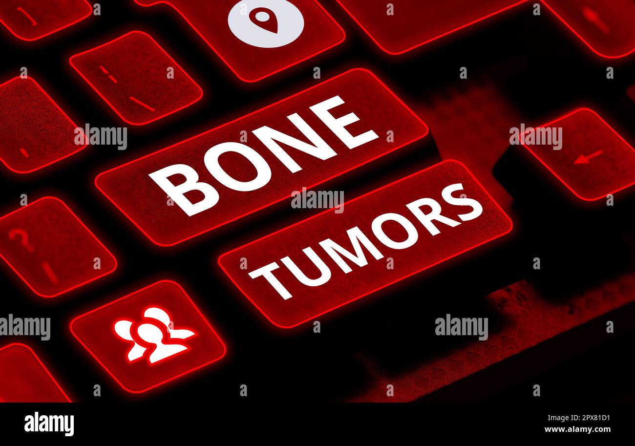 Bone tumors hi-res stock photography and images - Alamy