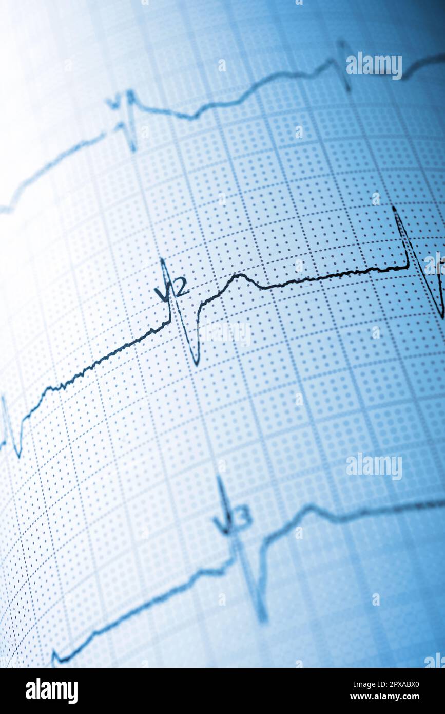 Electrocardiogram showing the pulse of the human heart Stock Photo - Alamy