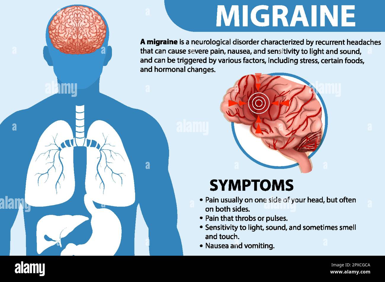 Informative poster of Migraine illustration Stock Vector Image & Art ...