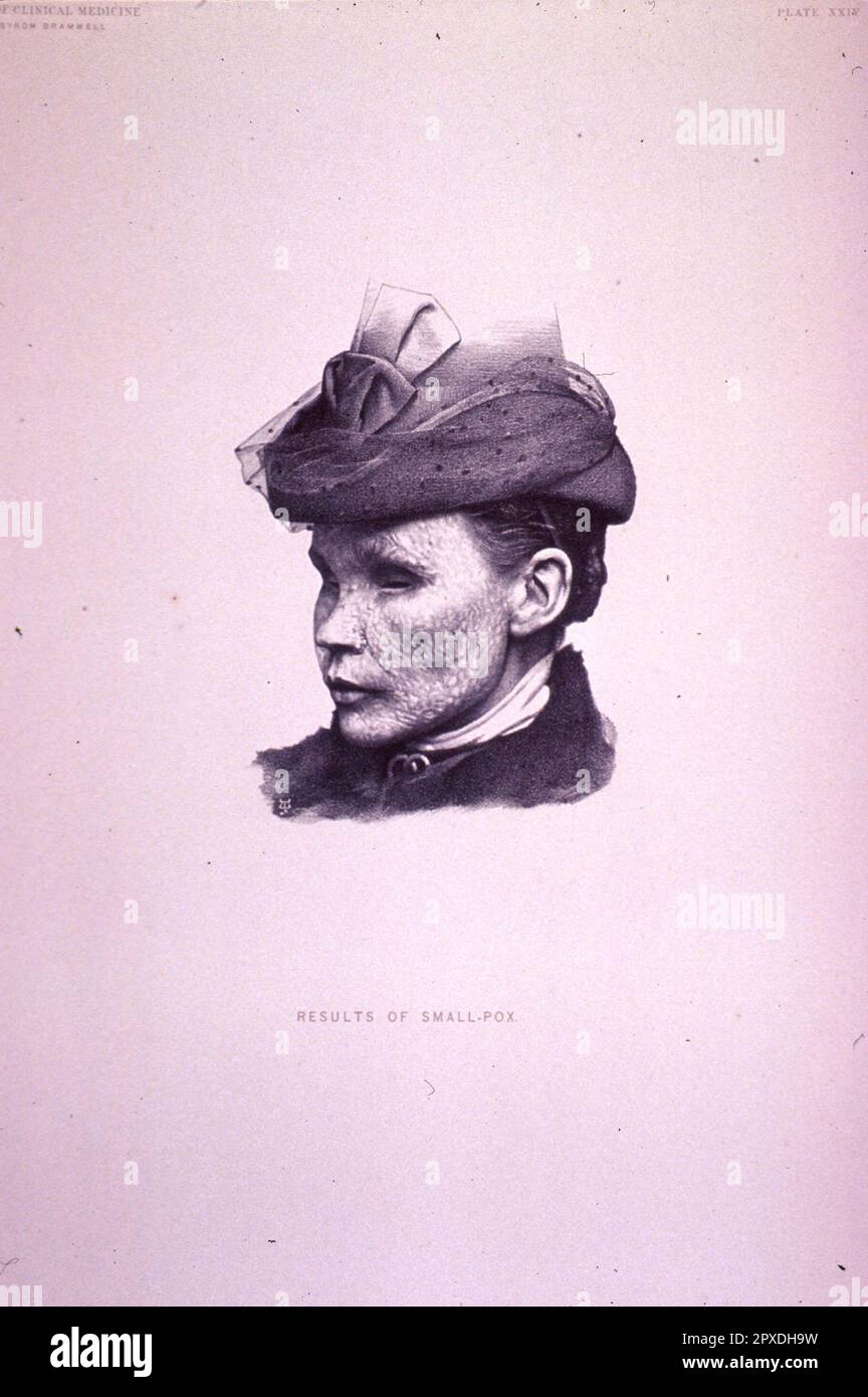 Pox image hi-res stock photography and images - Alamy