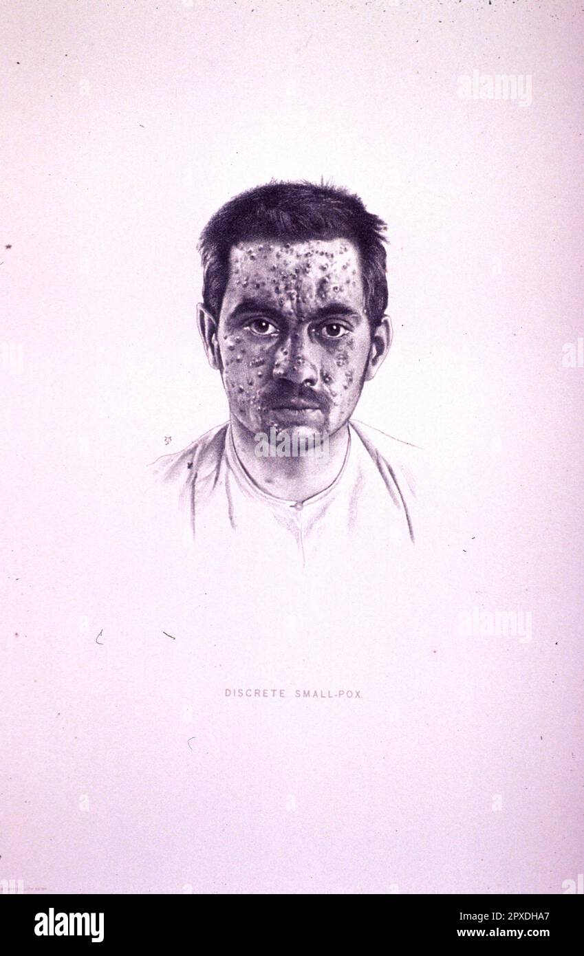 Pox image hi-res stock photography and images - Alamy