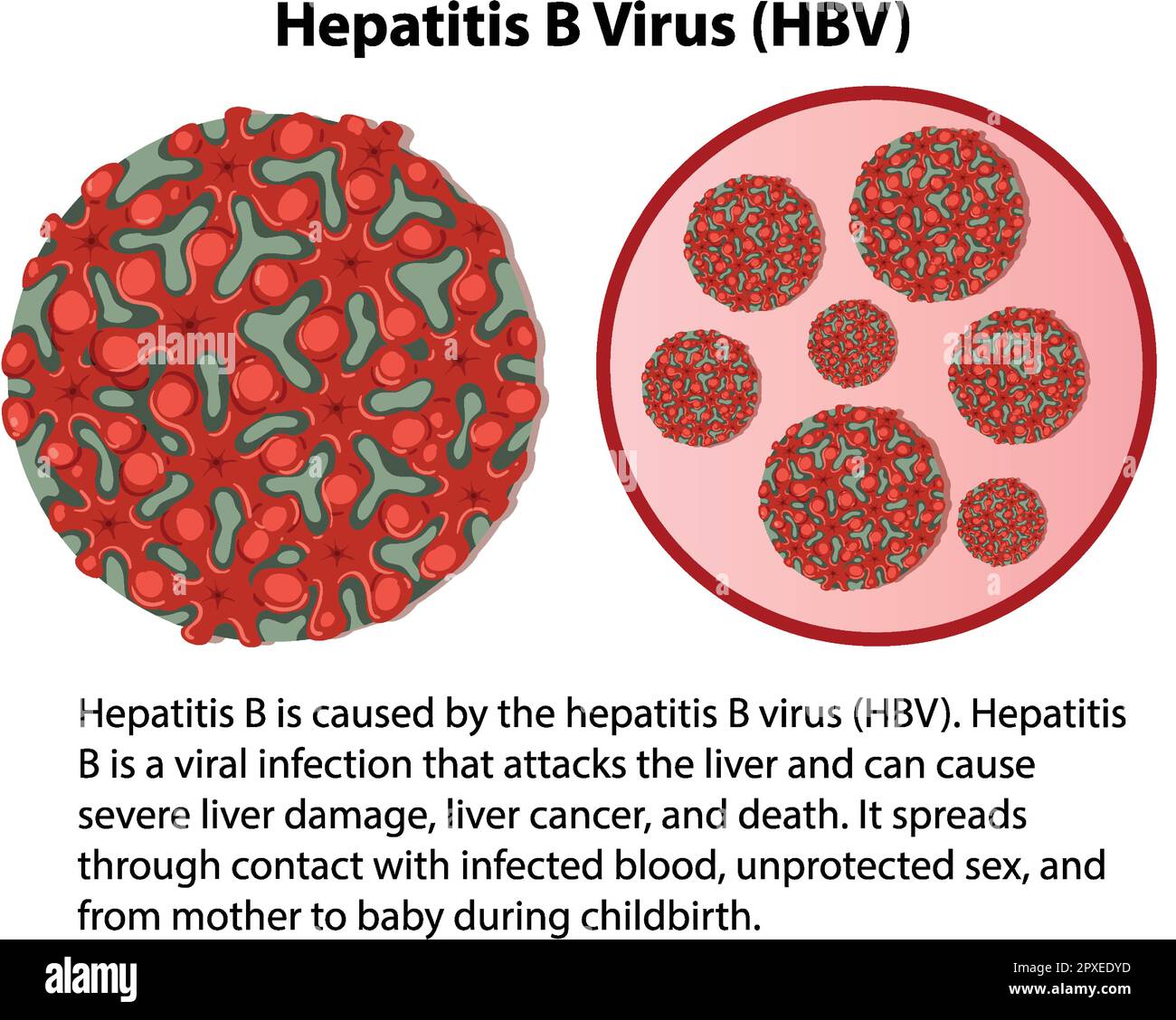 Hepatitis B Virus (HBV) with explanation illustration Stock Vector ...