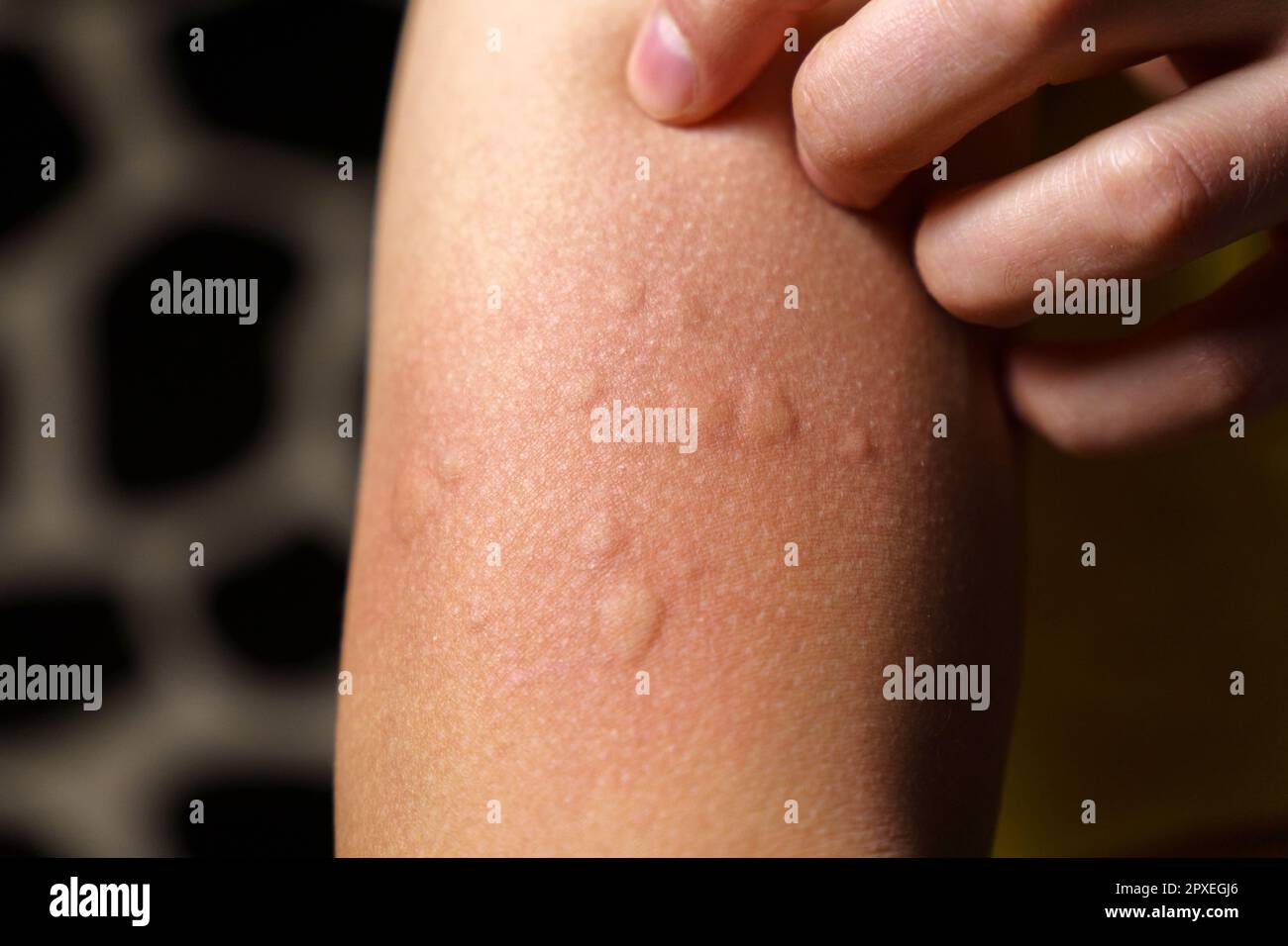 Injection site reaction hi-res stock photography and images - Alamy