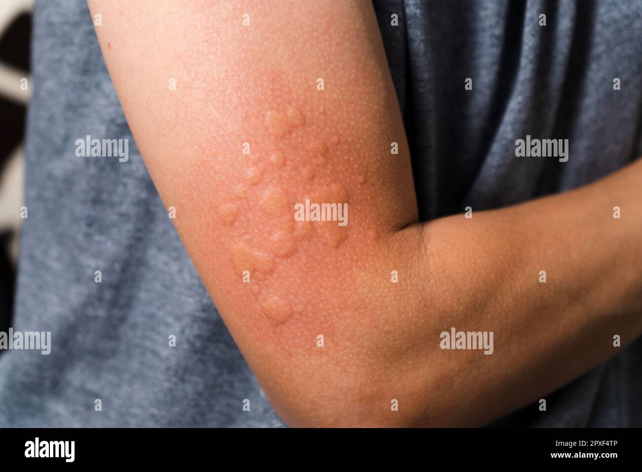 Skin texture, allergy shot, weeds, reaction Allergy symptoms Selective ...