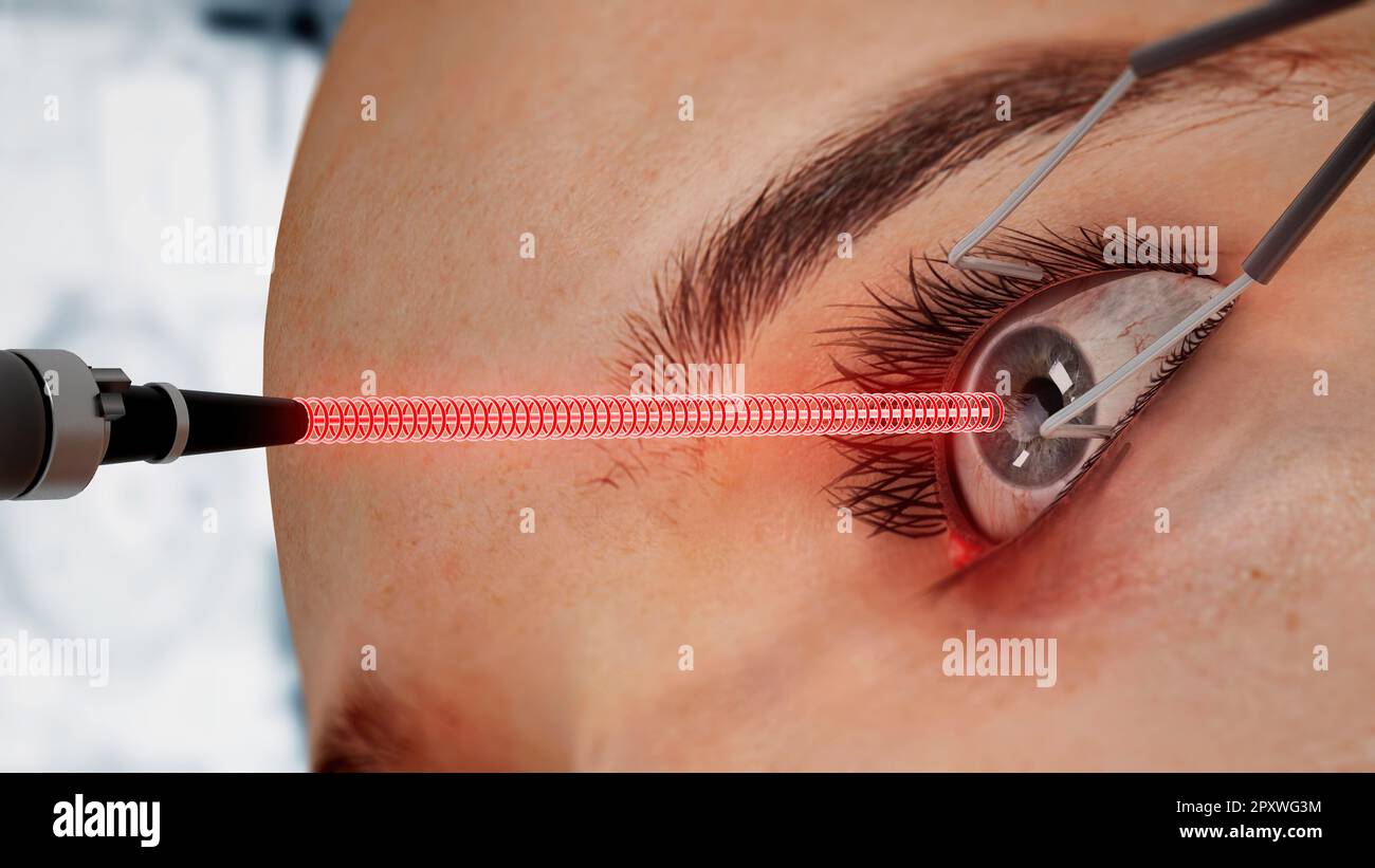 Laser eye surgery on 3D CGI character. 3D illustration Stock Photo - Alamy