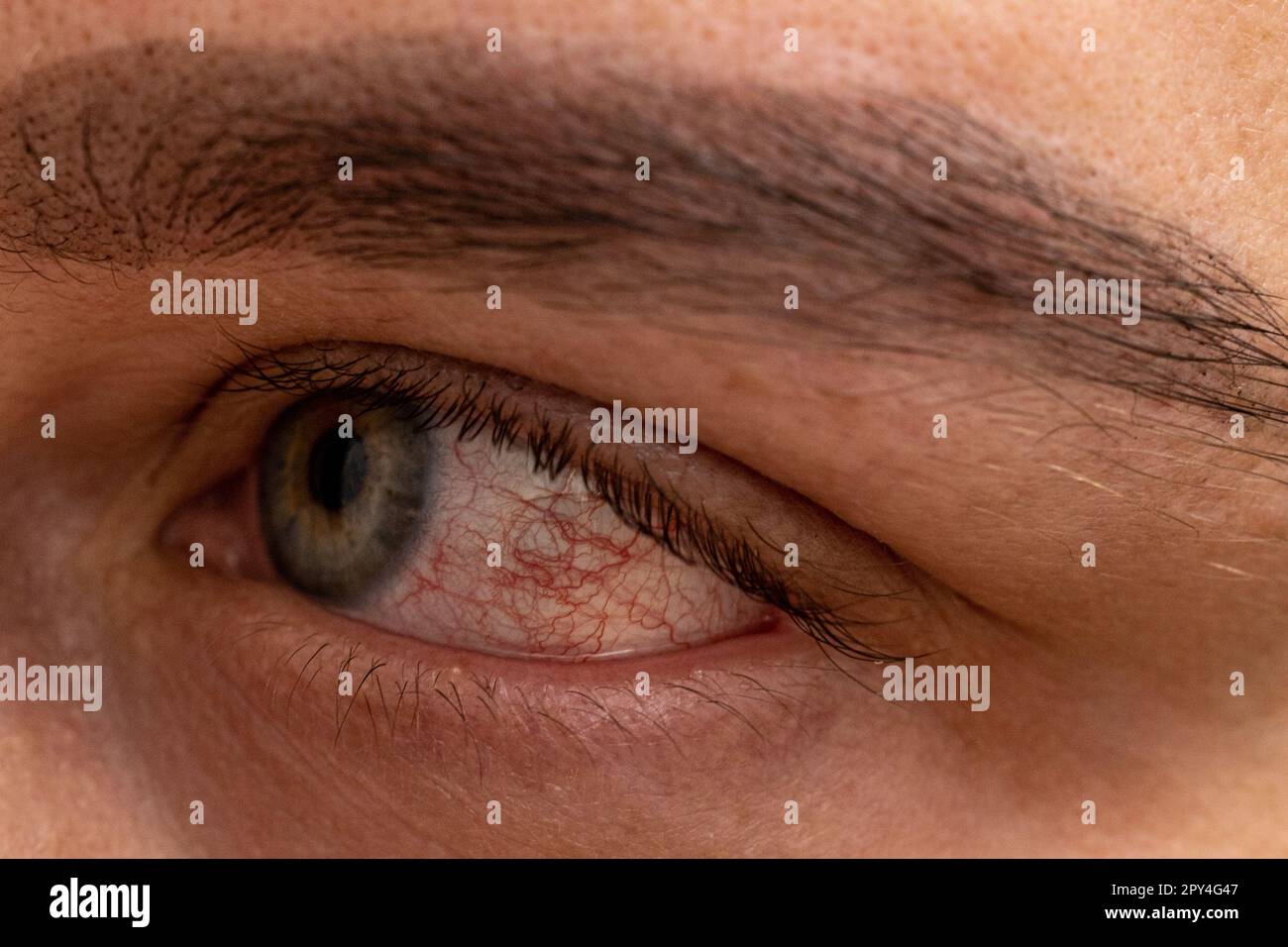 Allergic contact eczema dermatitis rash hi-res stock photography and ...