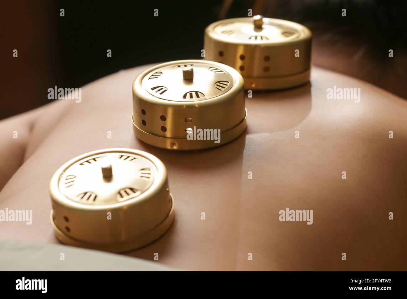 Moxibustion treatment - traditional Chinese medicine tools for acupuncture points heating ...