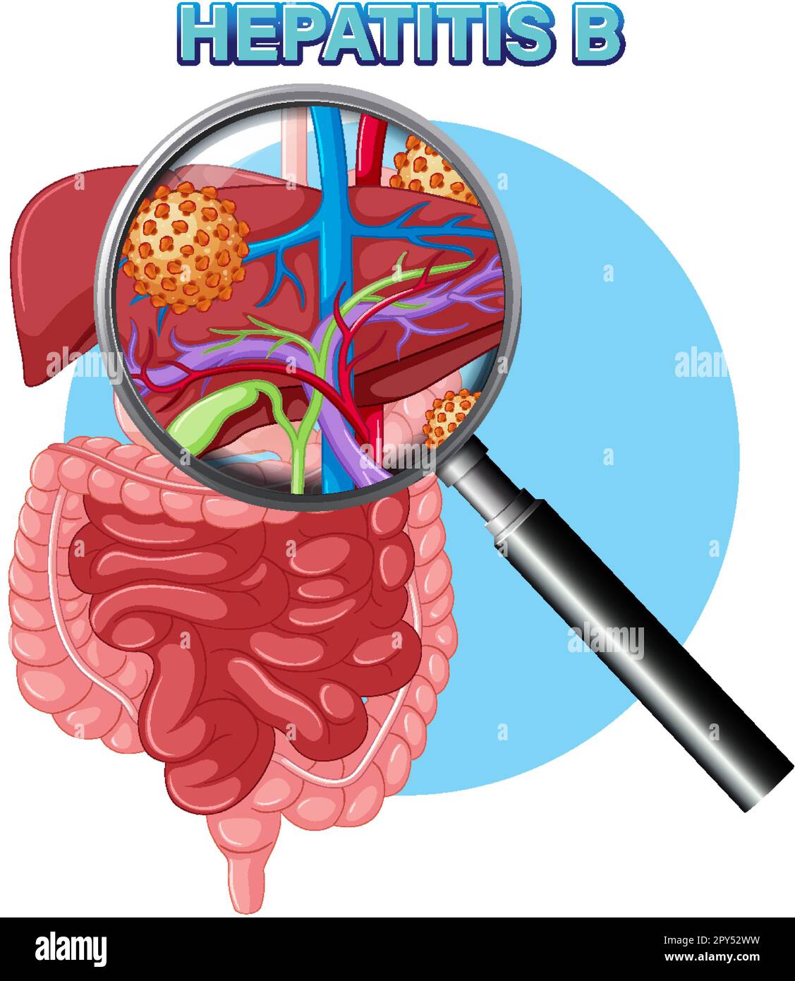 Hepatitis B liver infection virus illustration Stock Vector Image & Art ...