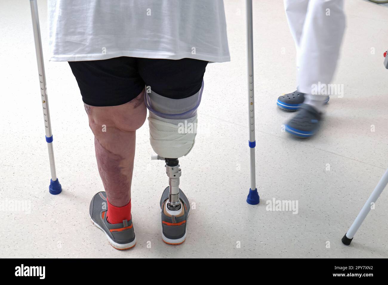 VYNNYKY, UKRAINE - MAY 1, 2023 - A patient with a prosthetic leg ...