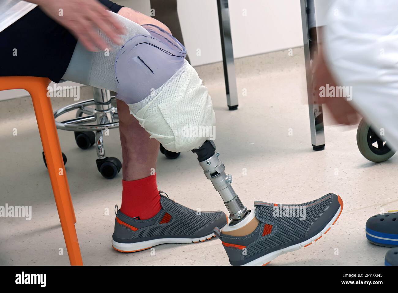 VYNNYKY, UKRAINE - MAY 1, 2023 - A patient with a prosthetic leg ...