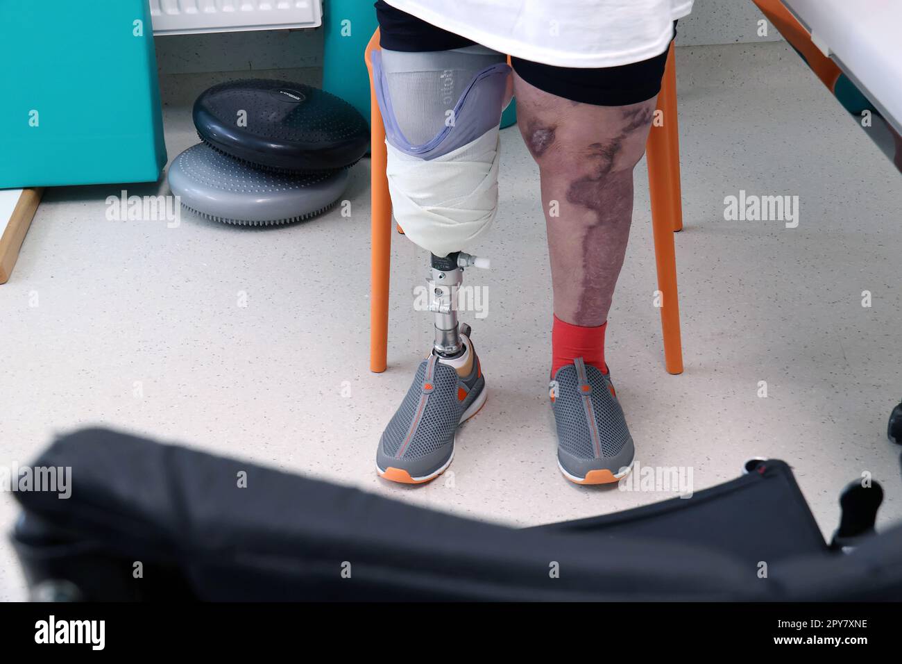 VYNNYKY, UKRAINE - MAY 1, 2023 - A patient with a prosthetic leg ...