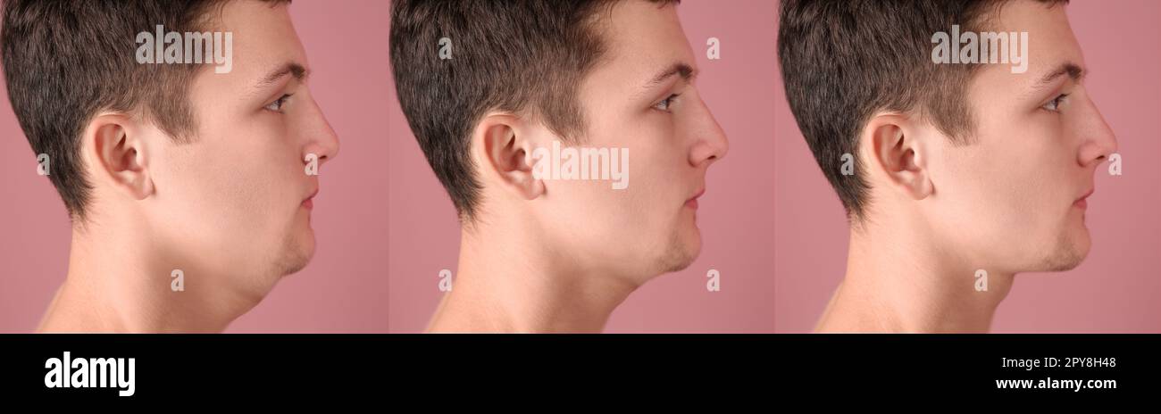 Double chin problem. Collage with photos of man before and after ...