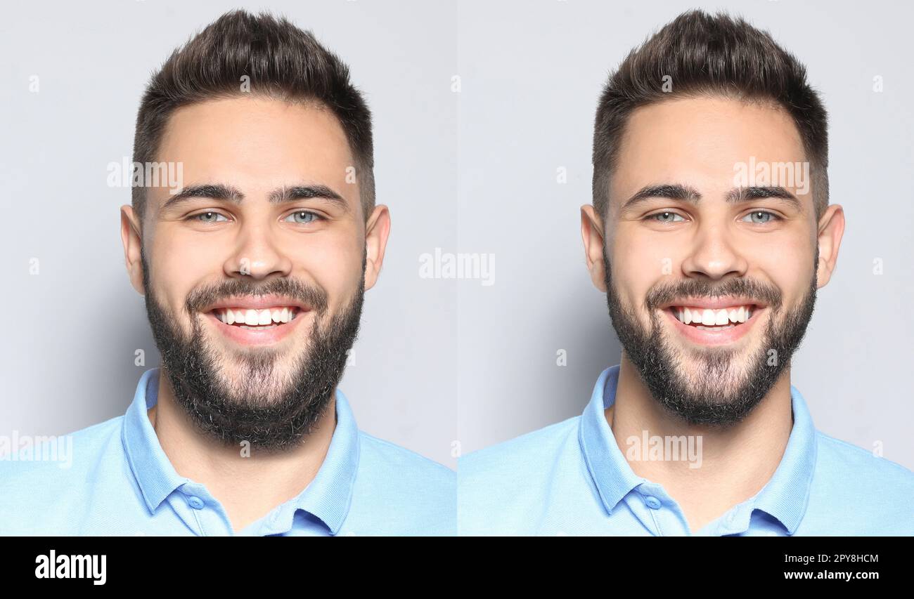 Double chin problem. Collage with photos of man before and after ...