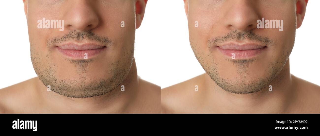 Double chin problem. Collage with photos of man before and after ...