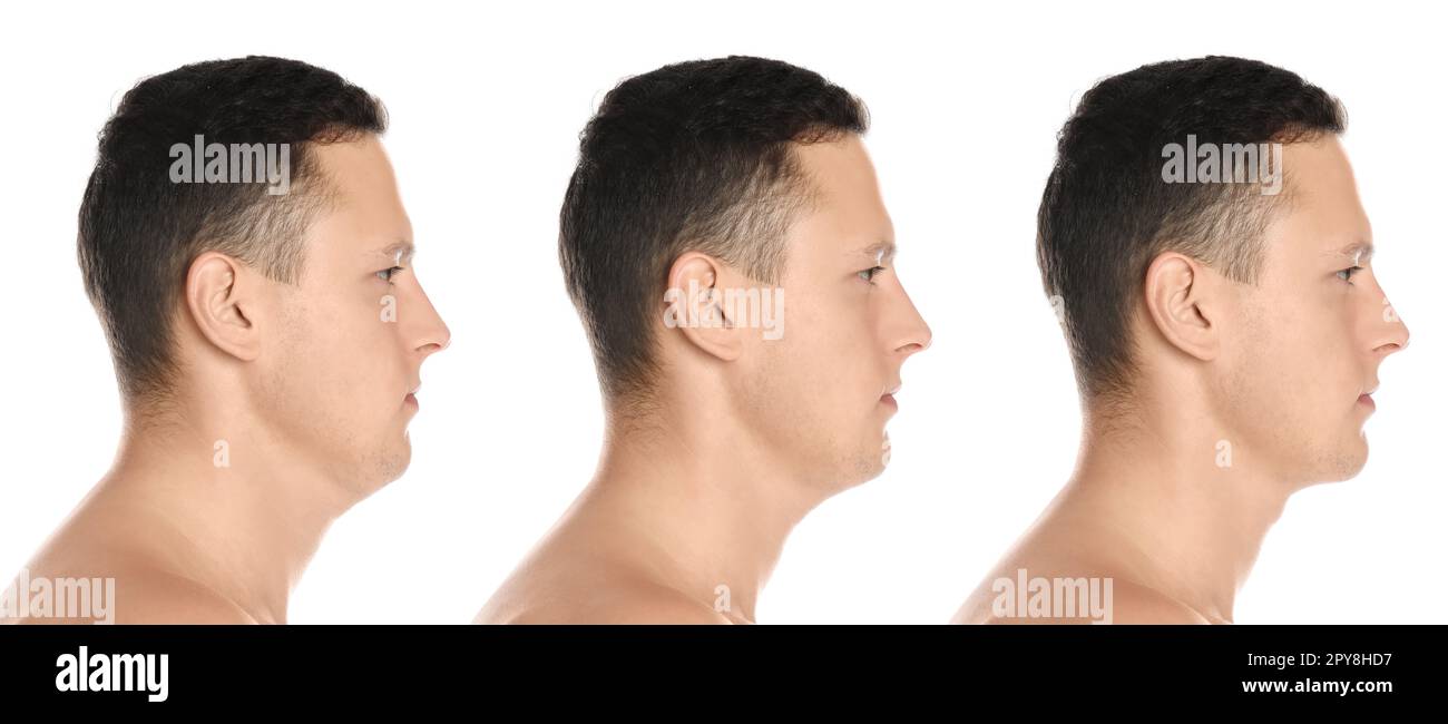 Double chin problem. Collage with photos of man before and after ...