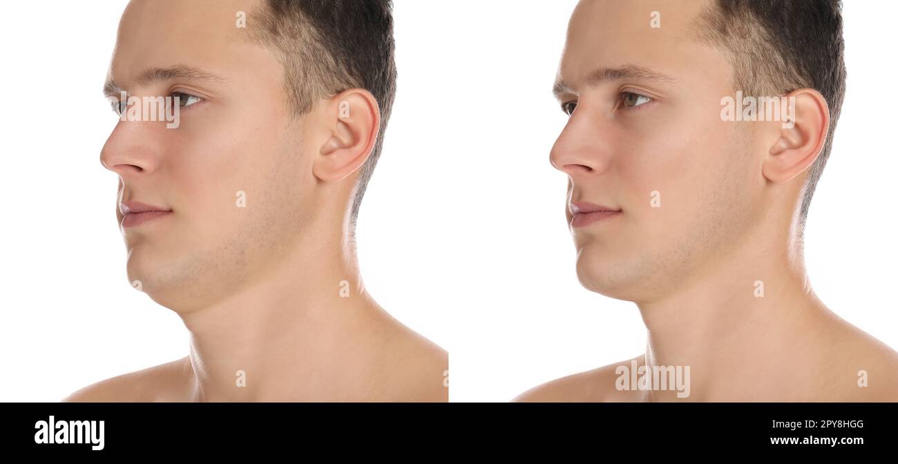 Double chin problem. Collage with photos of man before and after ...