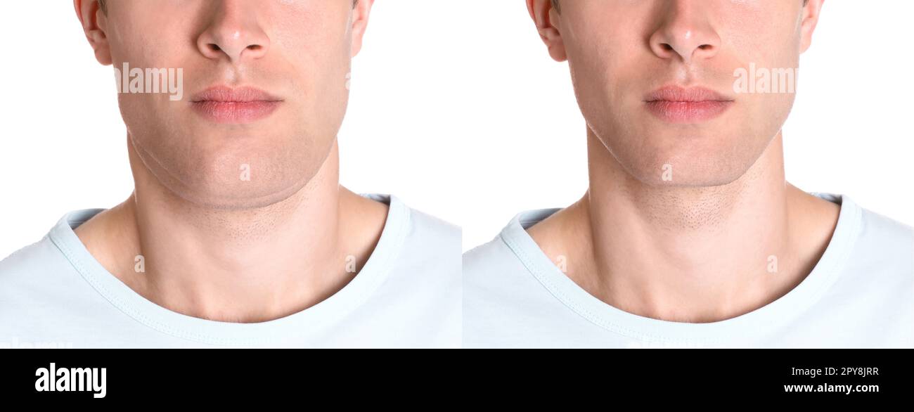 Double chin problem. Collage with photos of man before and after ...