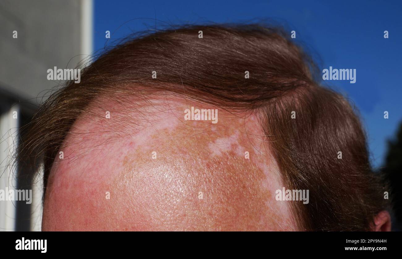 Vitiligo is a medical condition causing depigmentation of patches of ...