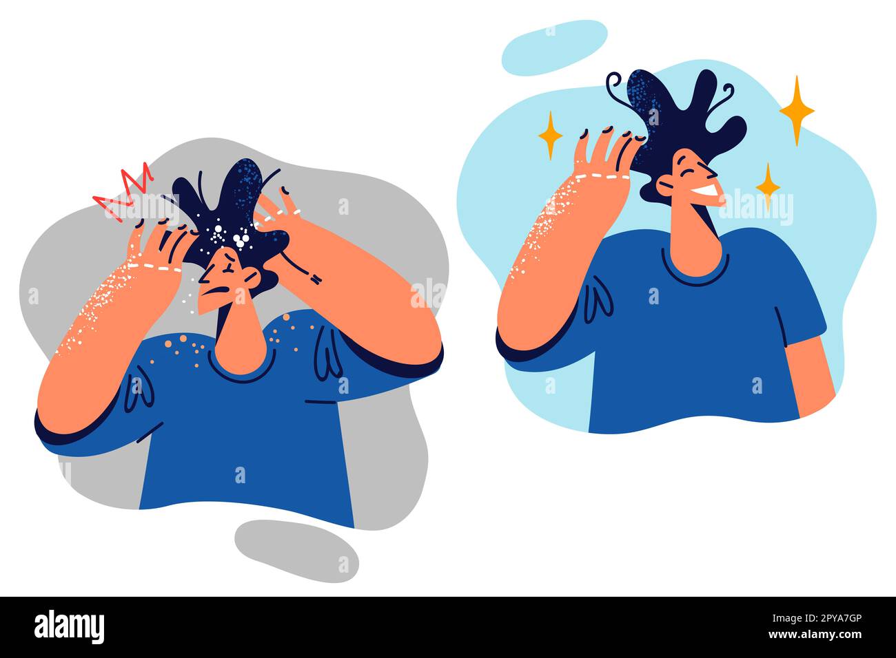 Man suffering from dandruff in hair rejoices after using quality ...