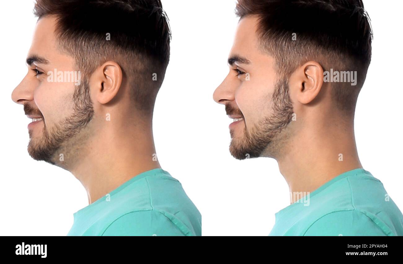 Double chin problem. Collage with photos of man before and after ...