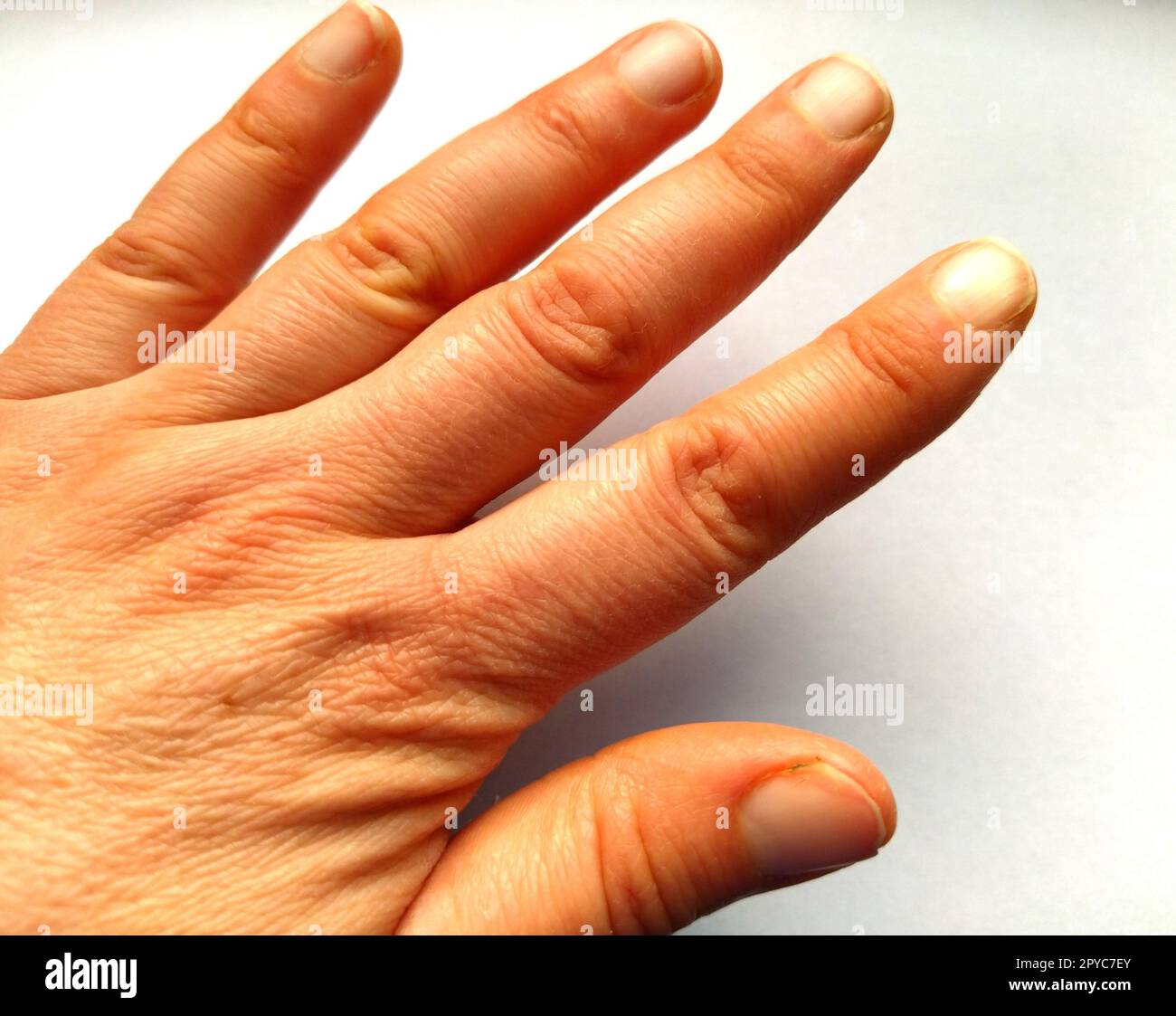 Anti skin rash hi-res stock photography and images - Alamy