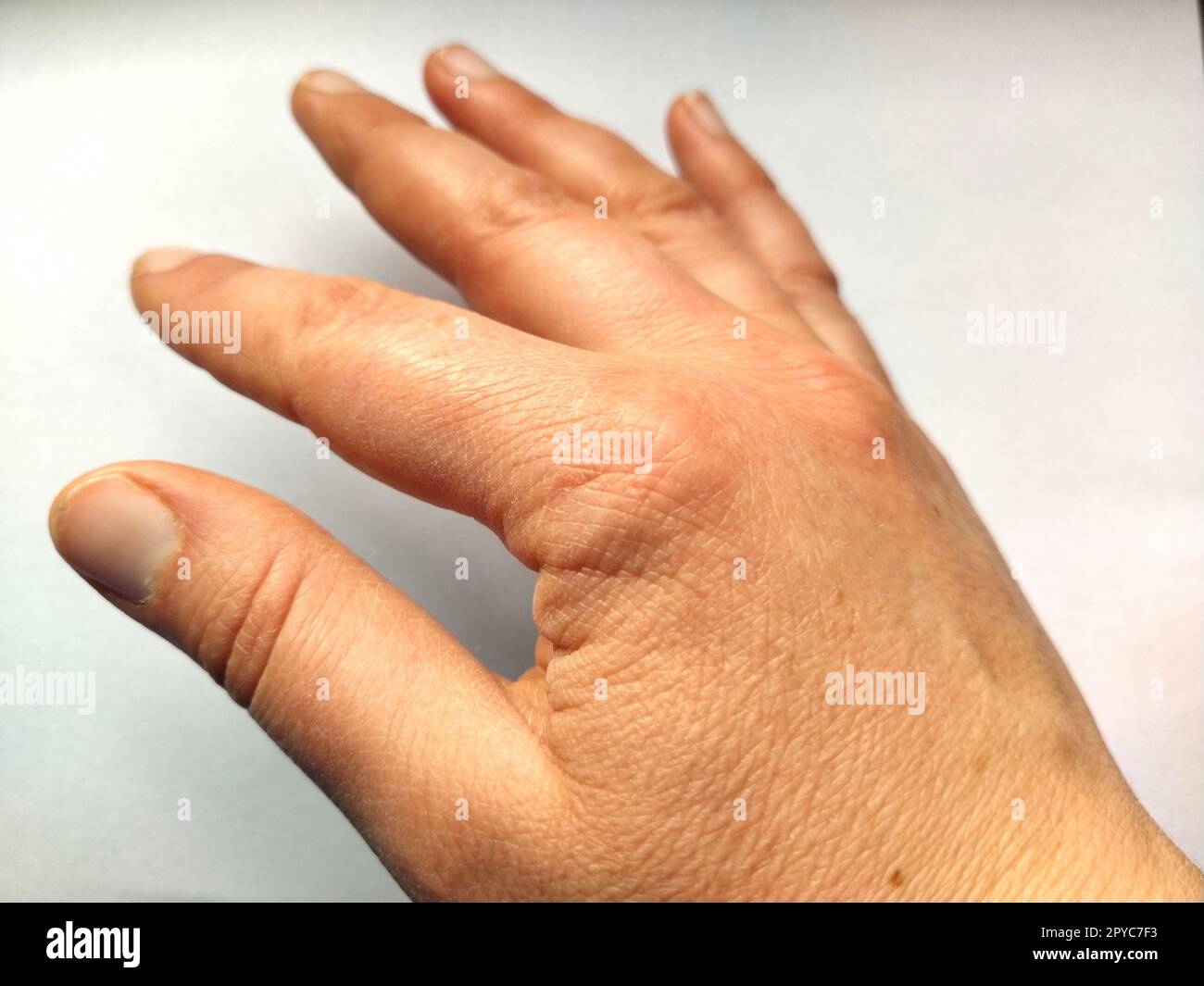 Female hand with dry atopic skin and sore joints. White background ...
